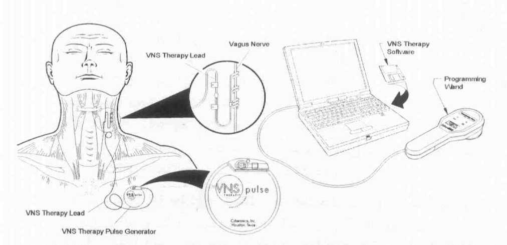 Medical Technology VNS